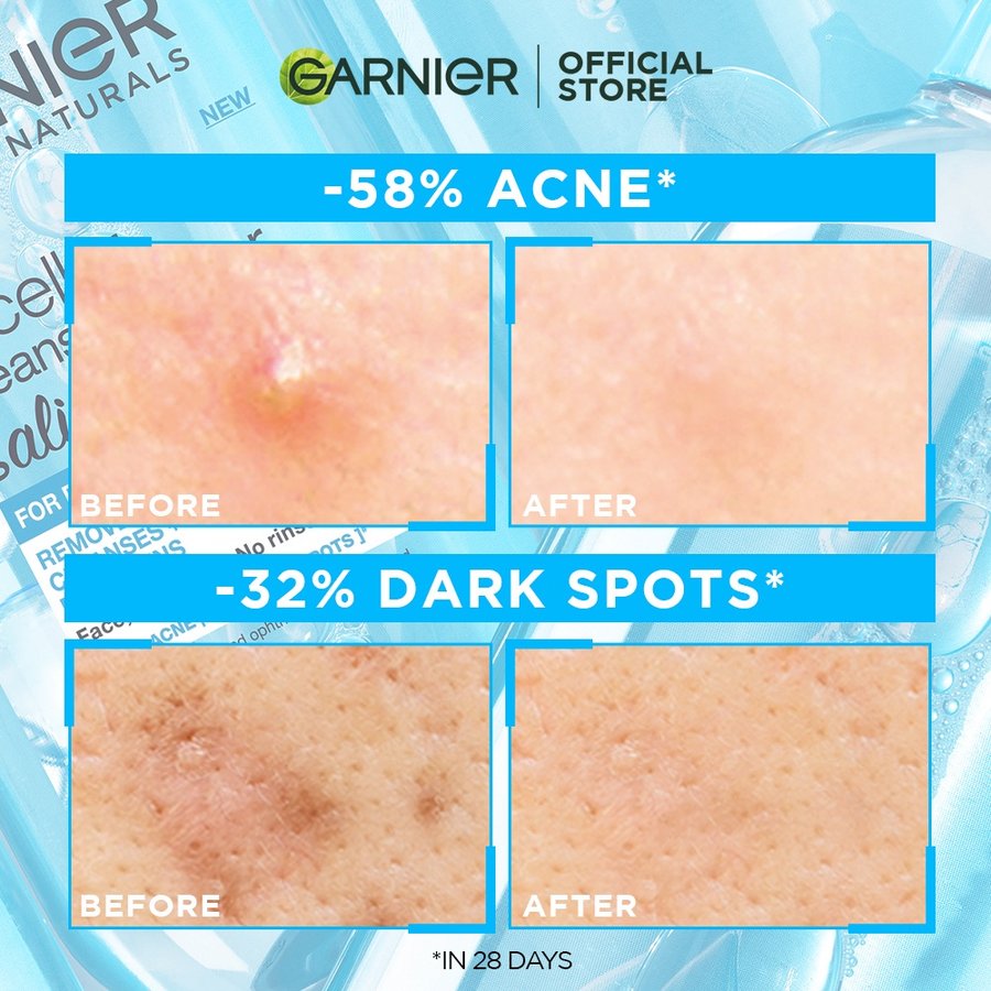 Bright Complete Anti-Acne Cleanser: Fights Acne & Brightens | Garnier
